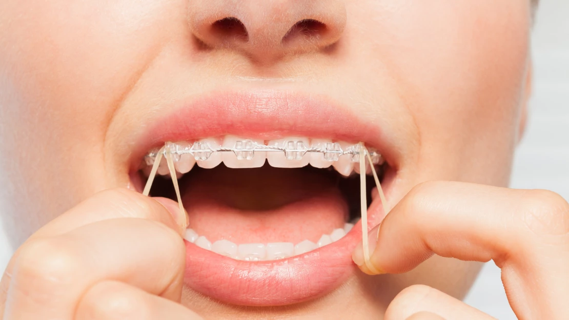 Everything You Need to Know About Braces: Answers to Common Questions ...